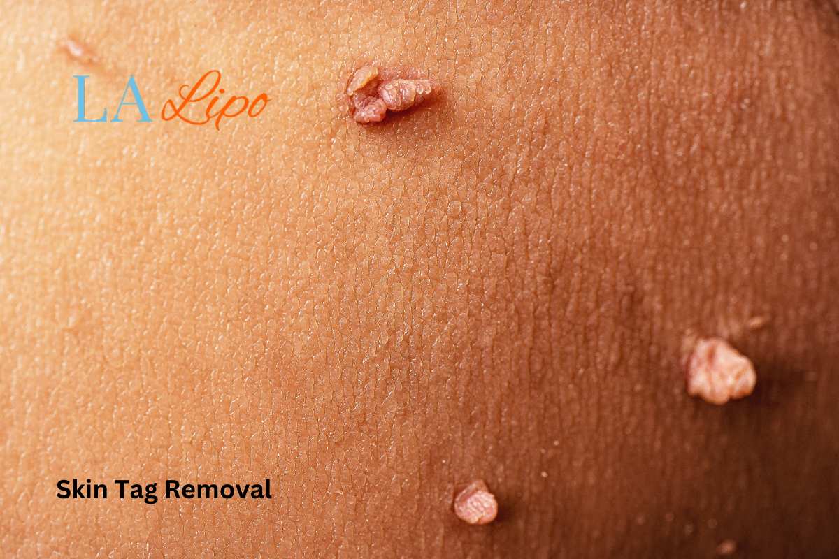What Does Skin Look After Skin Tag Removal Spalding